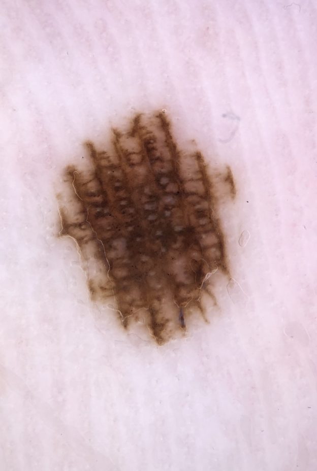 Dermatoskopi i primärvård del 2 - Göteborg - Distriktsläkare.com